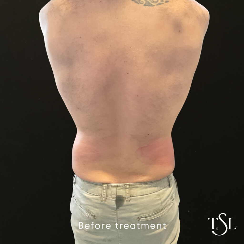 Stubborn Fat Removal - Men | The Skin Lab