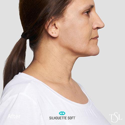 Thread Lifts | The Skin Lab