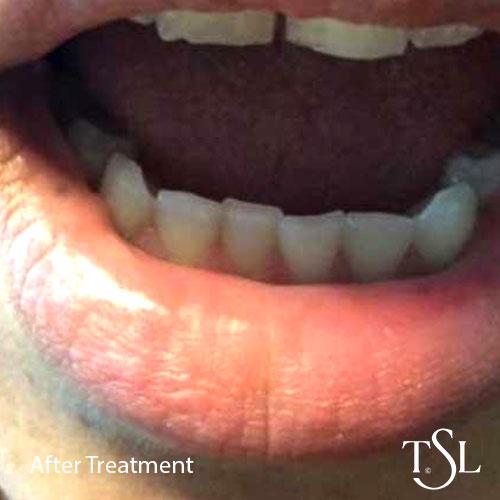 Lip Rejuvenation | The Skin Lab