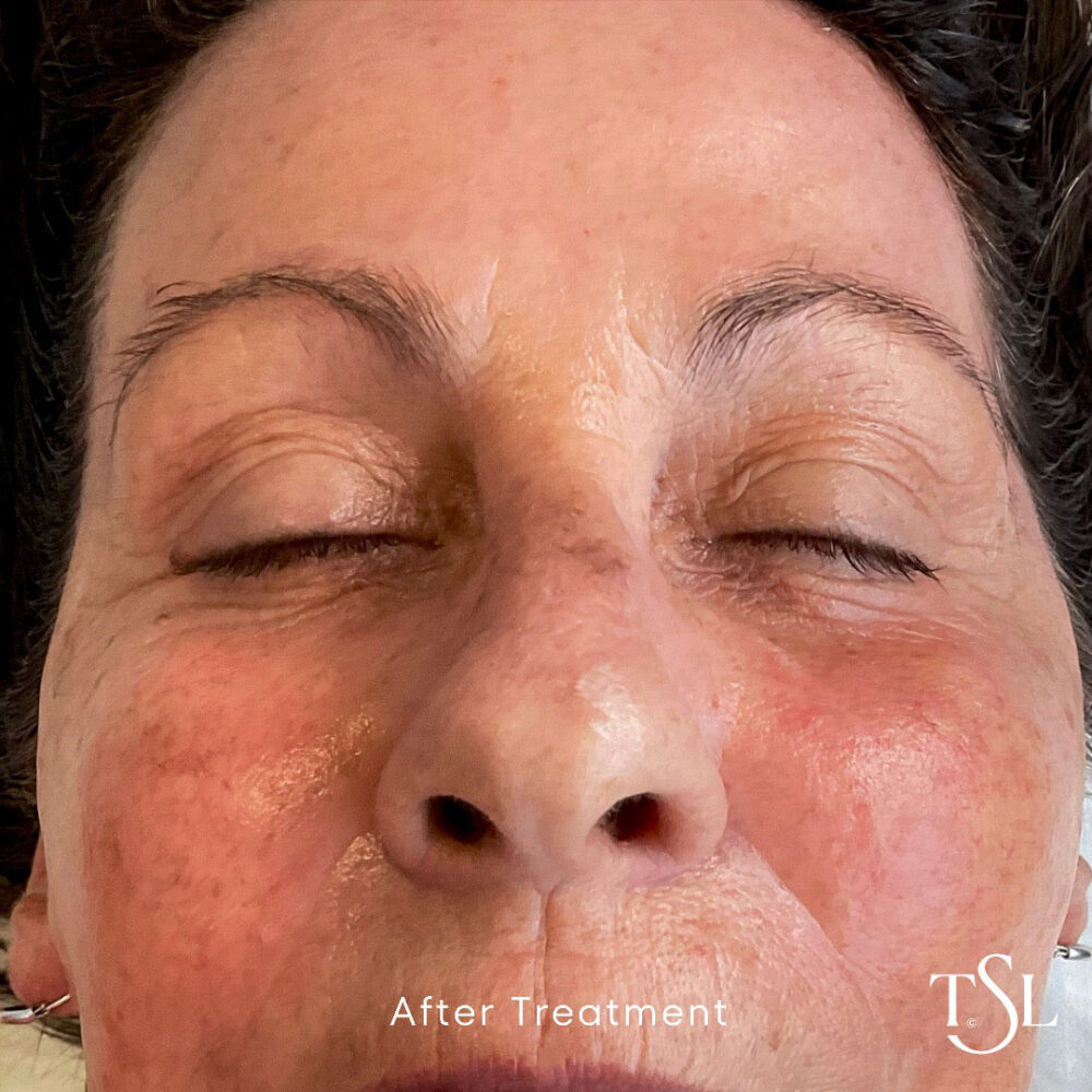 Effective Dermaplaning Treatment | The Skin Lab