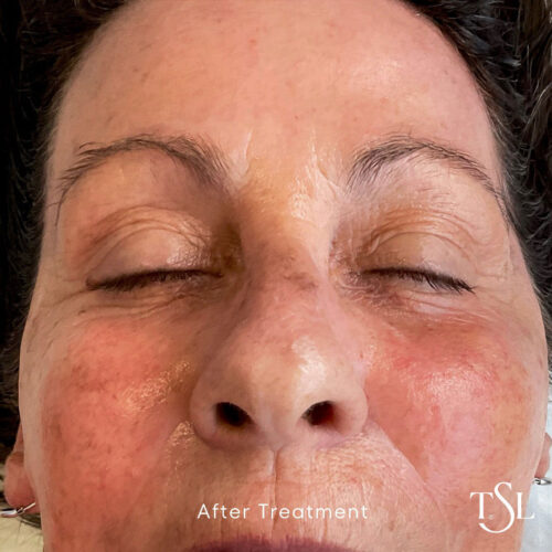 Effective Dermaplaning Treatment | The Skin Lab