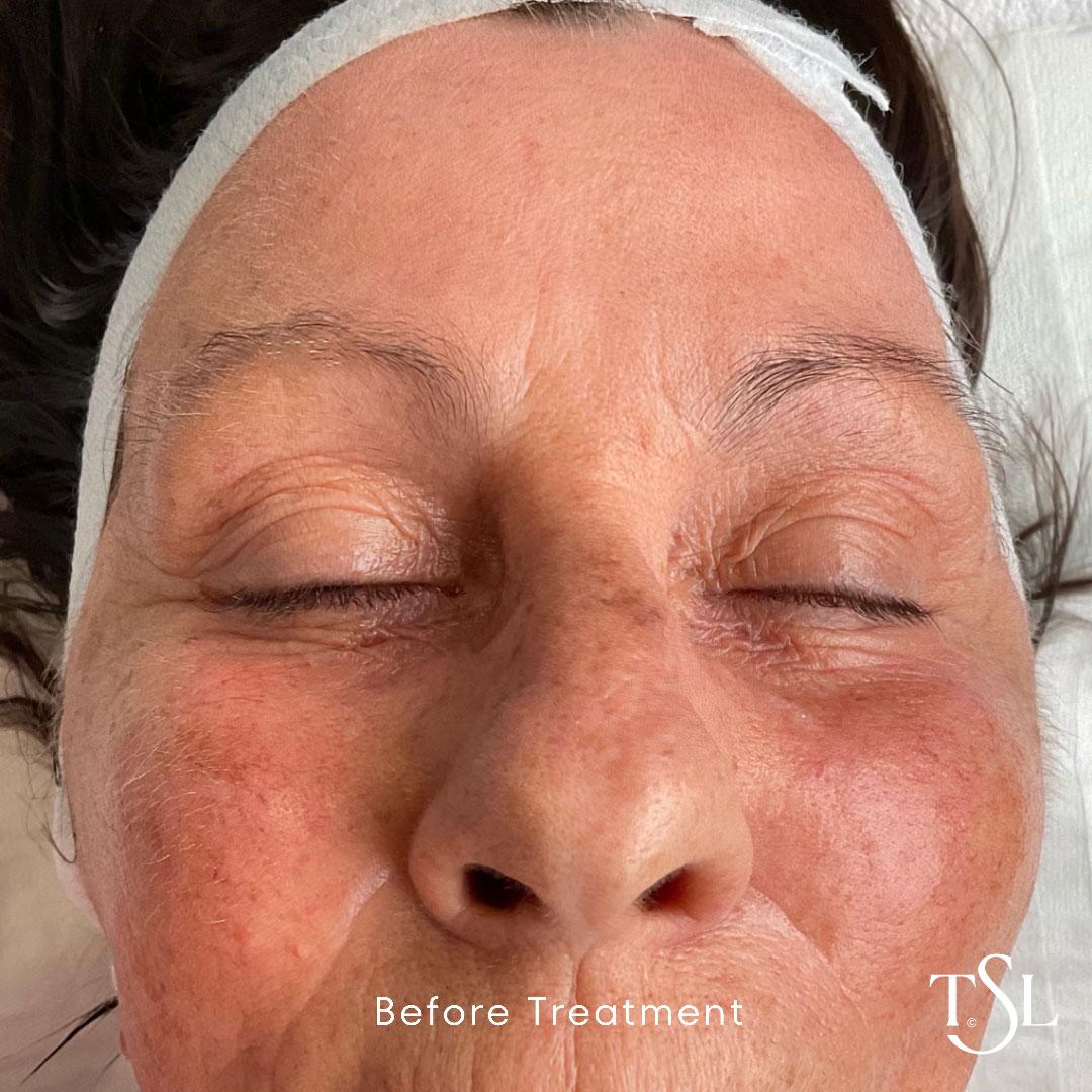 Effective Dermaplaning Treatment | The Skin Lab