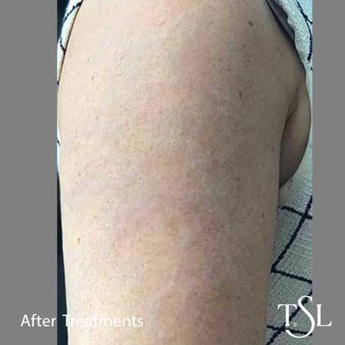 Tattoo Removal | The Skin Lab