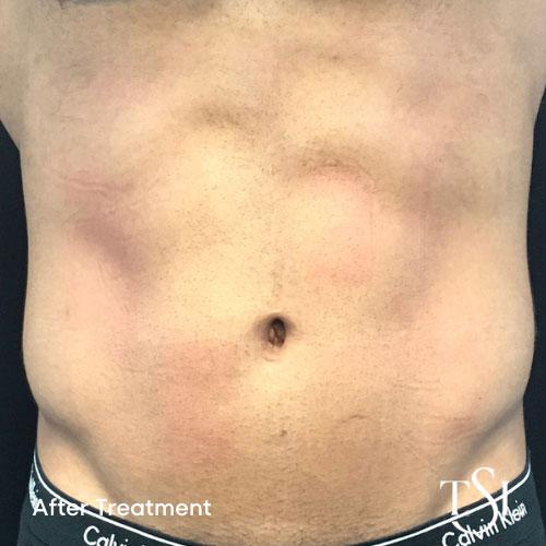 TruSculpt Flex Muscle Sculpting | The Skin Lab