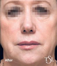 Hybrid Dermal Filler | The Skin Lab