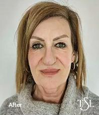 Hybrid Dermal Filler | The Skin Lab