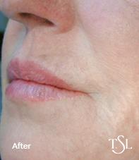 Hybrid Dermal Filler | The Skin Lab