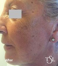 Collagen Biostimulant | The Skin Lab