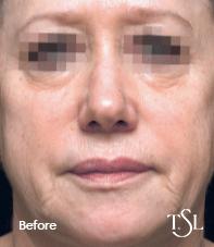 Hybrid Dermal Filler | The Skin Lab