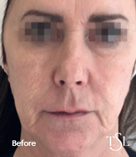 Hybrid Dermal Filler | The Skin Lab