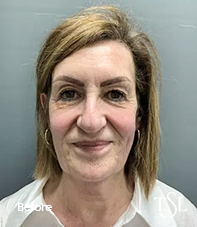 Hybrid Dermal Filler | The Skin Lab