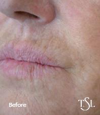 Hybrid Dermal Filler | The Skin Lab