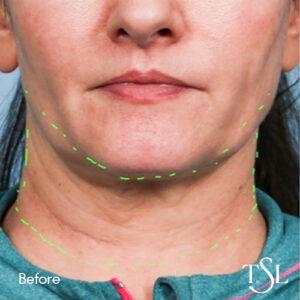 Secret RF Microneedling Treatment | The Skin Lab