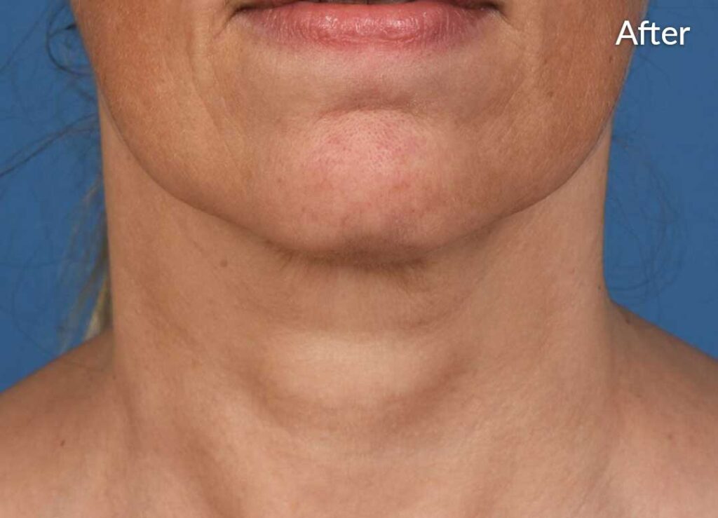 Skin Needling Treatment | The Skin Lab