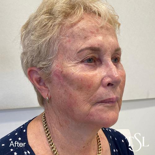 Collagen Biostimulant | The Skin Lab