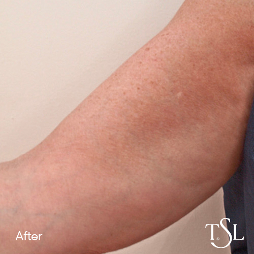 Collagen Biostimulant | The Skin Lab