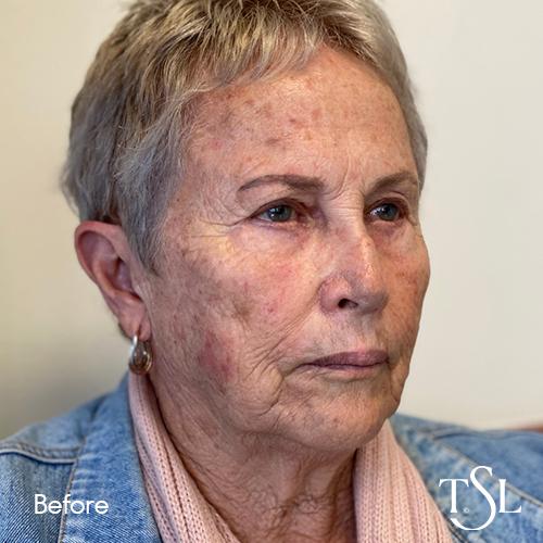 Collagen Biostimulant | The Skin Lab