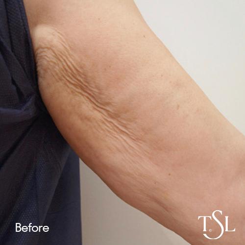 Collagen Biostimulant | The Skin Lab