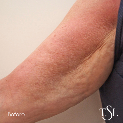 Collagen Biostimulant | The Skin Lab