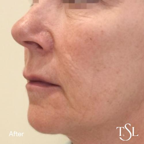 Hybrid Dermal Filler | The Skin Lab