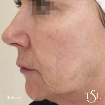 Hybrid Dermal Filler | The Skin Lab