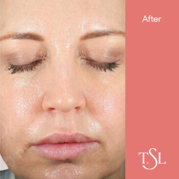 CoolPeel CO2 Laser | The Skin Lab