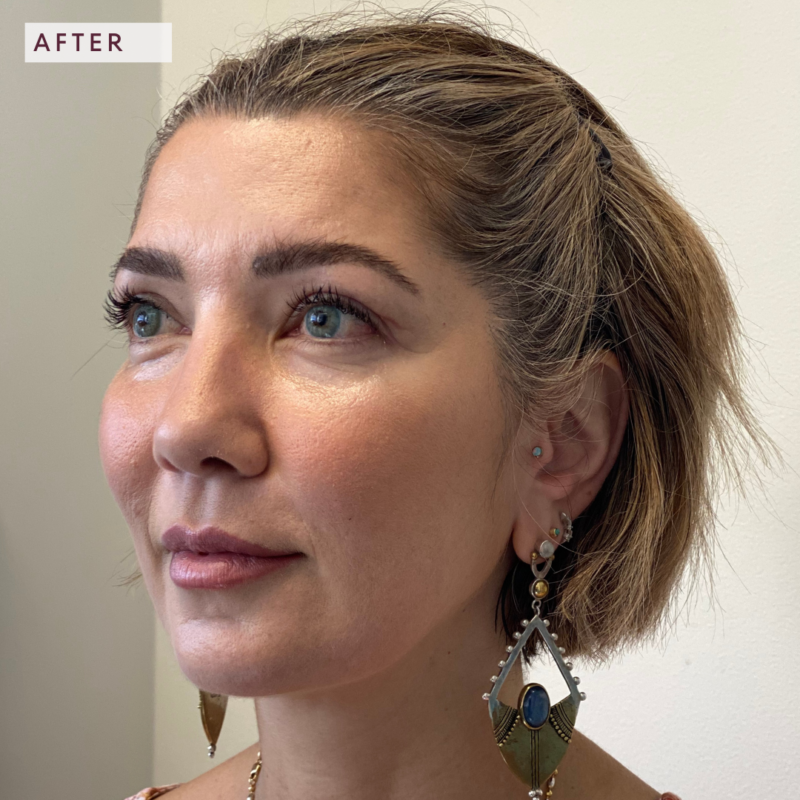 Cheek Dermal Fillers | The Skin Lab