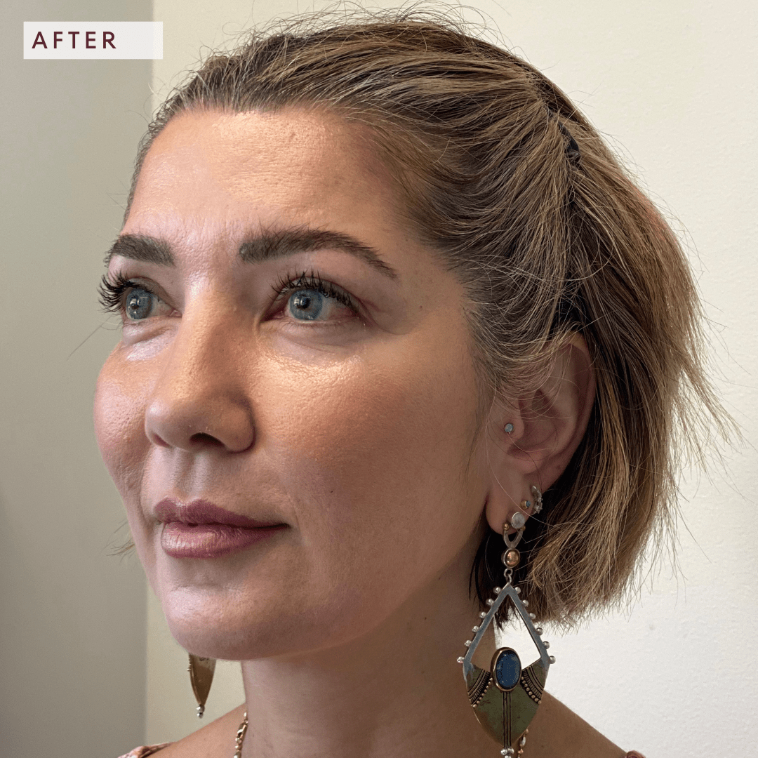 Cheek Dermal Fillers | The Skin Lab