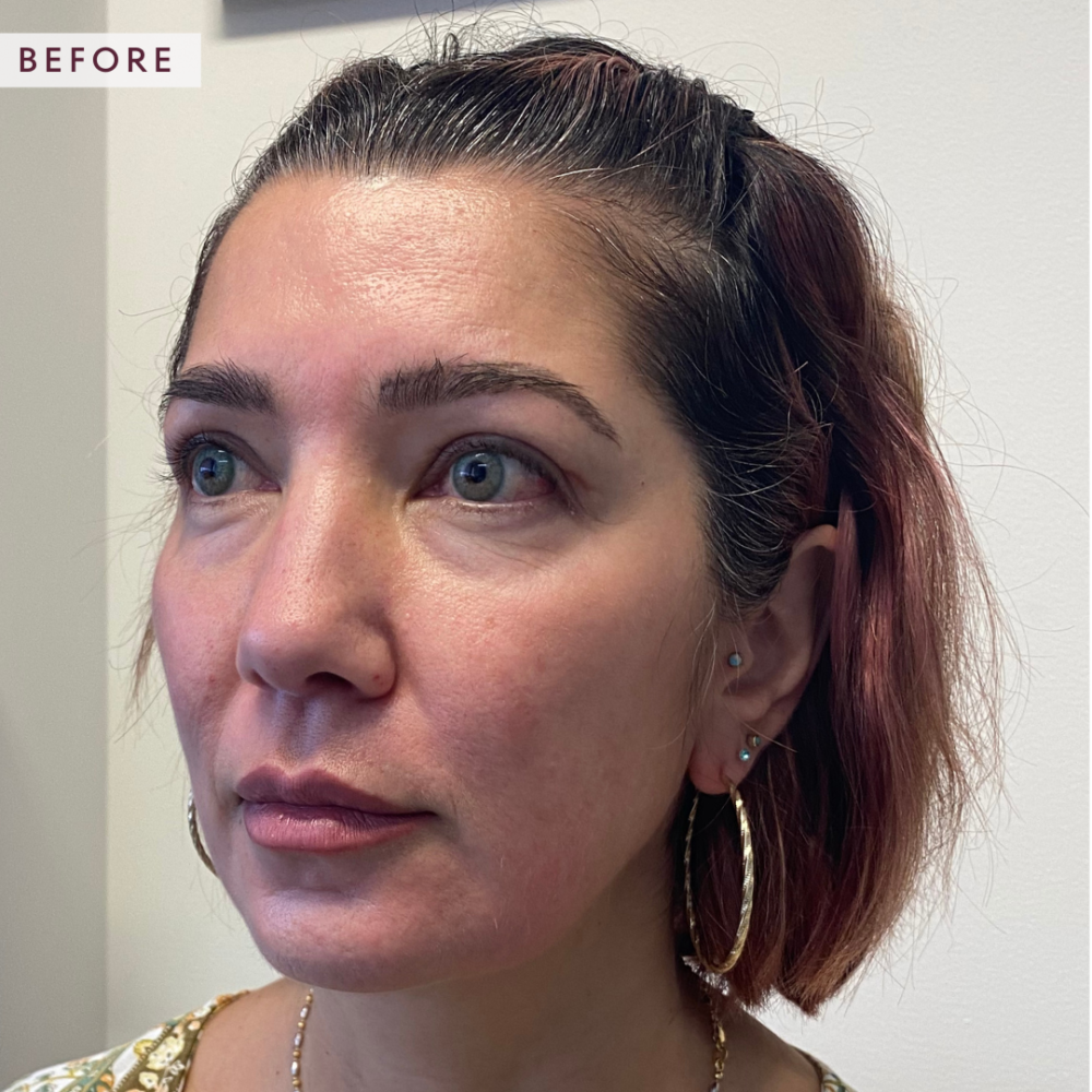 Cheek Dermal Fillers | The Skin Lab
