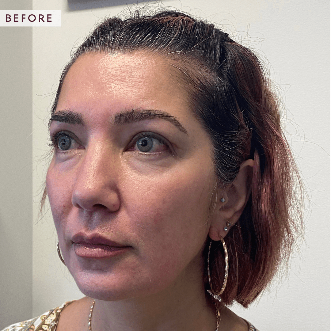 Cheek Dermal Fillers | The Skin Lab